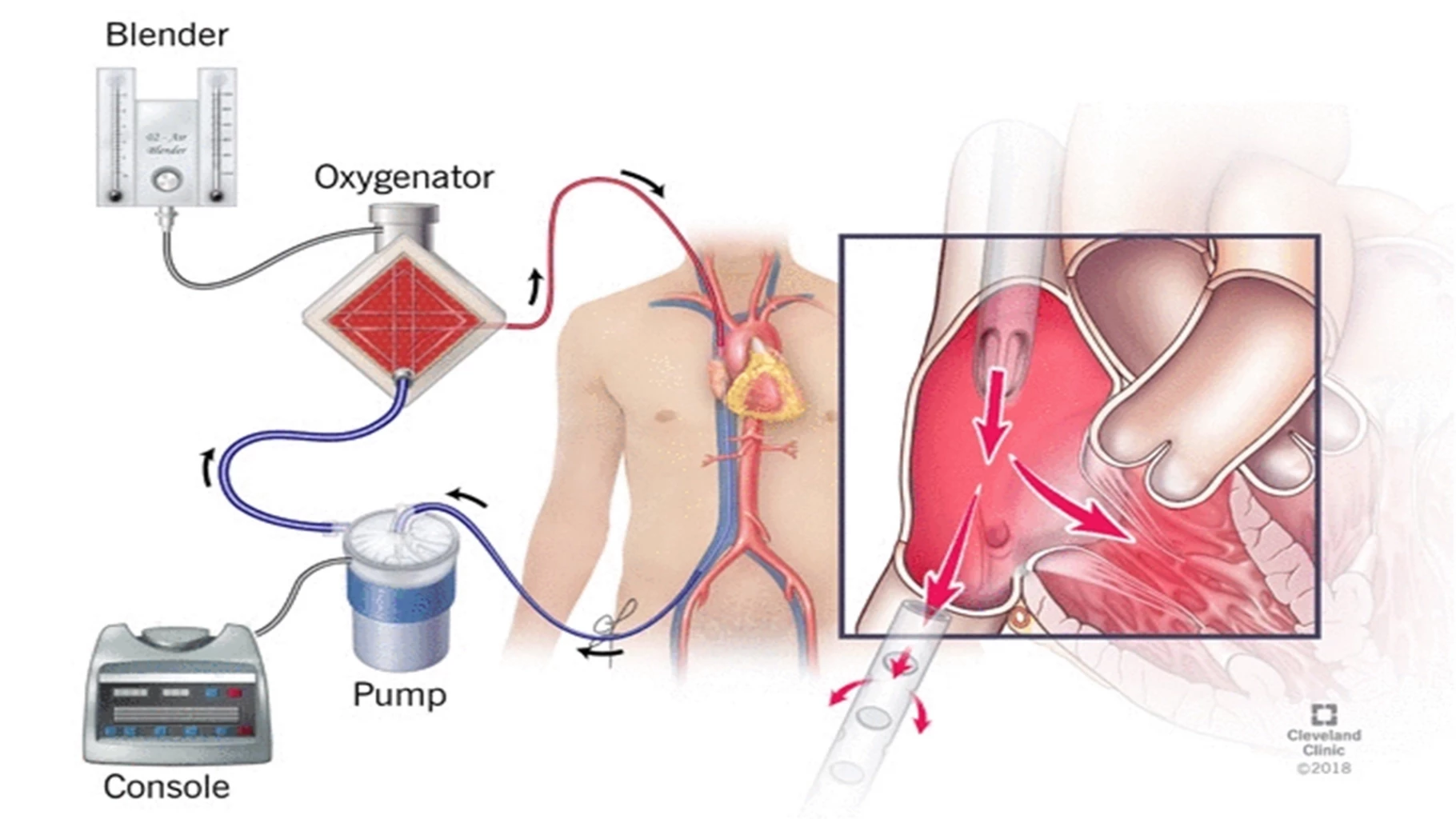 ECMO เครื่องปอดและหัวใจเทียม อุปกรณ์พยุงชีพชิ้นสำคัญ